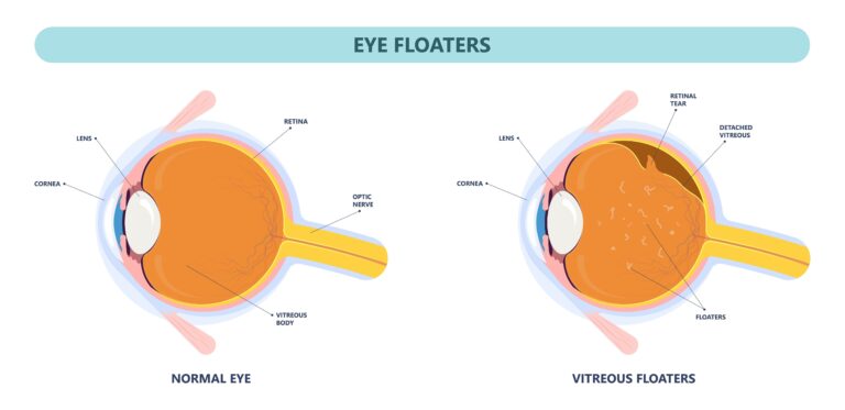 What Are Eye Floaters and How Do I Get Rid of Them? - Inspired Eyes ...
